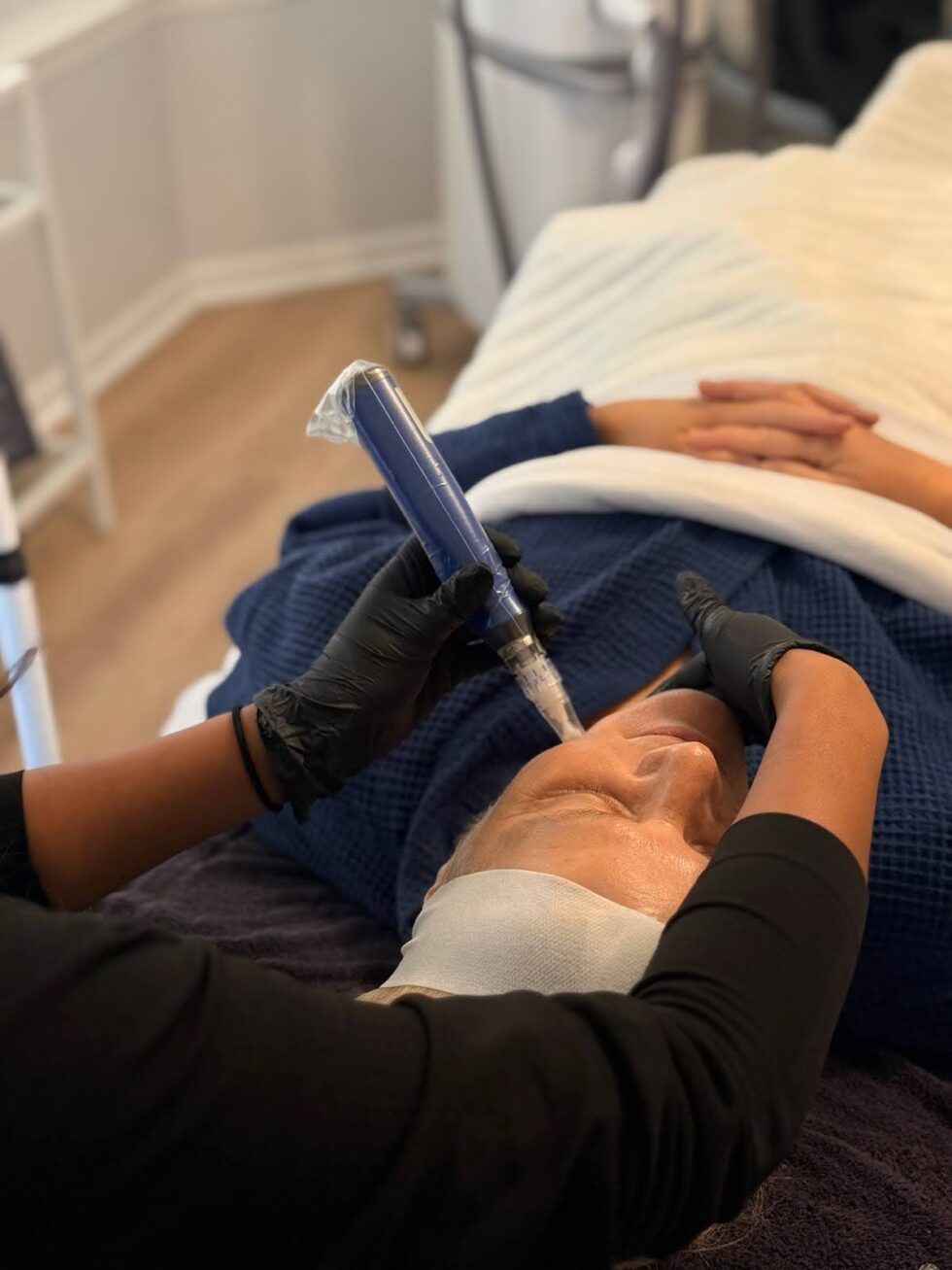 Advanced SkinPen Microneedling w/Exosomes | Aura Health & Spa in ...